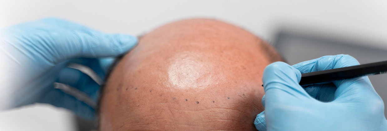 SVF (Kök Hücre) ve Eksozom Tedavisi - Görkem Kazan Hair Transplant SVF ...